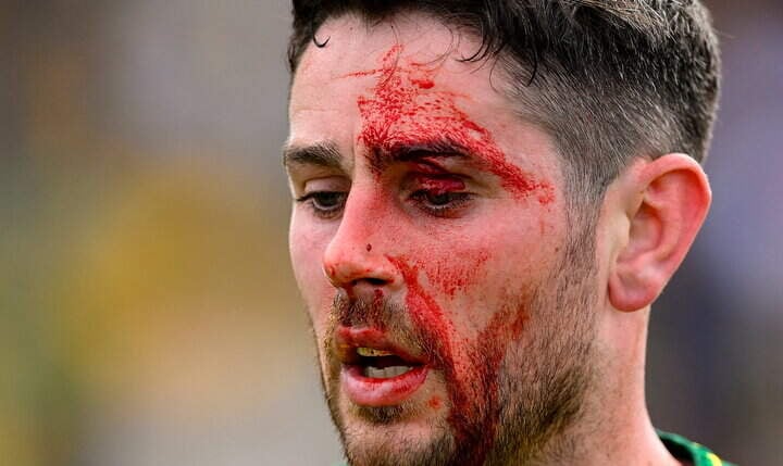 Donegal vs Kerry fight: GAA red card, Jim McGuinness ban risk | Belfast ...