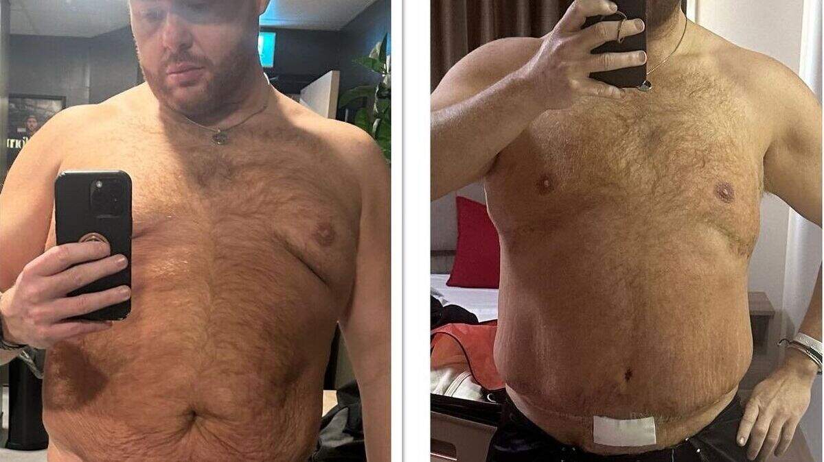 ‘Proud’ make-up star Paddy McGurgan shows off his Turkey tummy-tuck ...